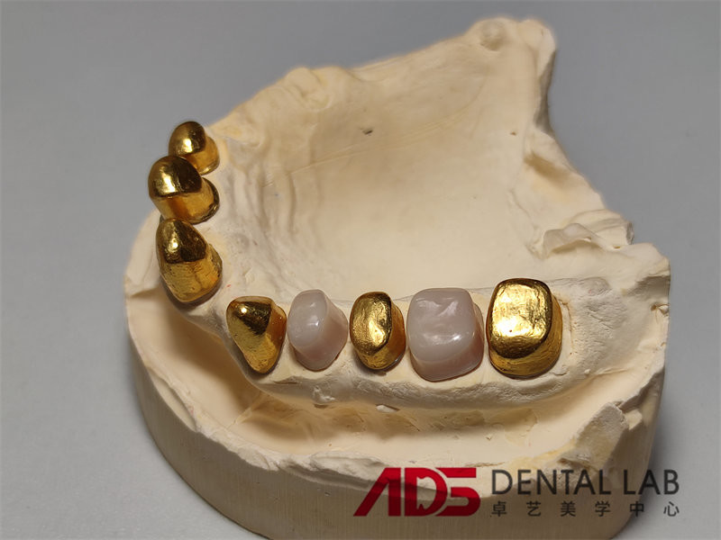 ADS Precision Attachment Dental Telescopic Crowns Mechanism